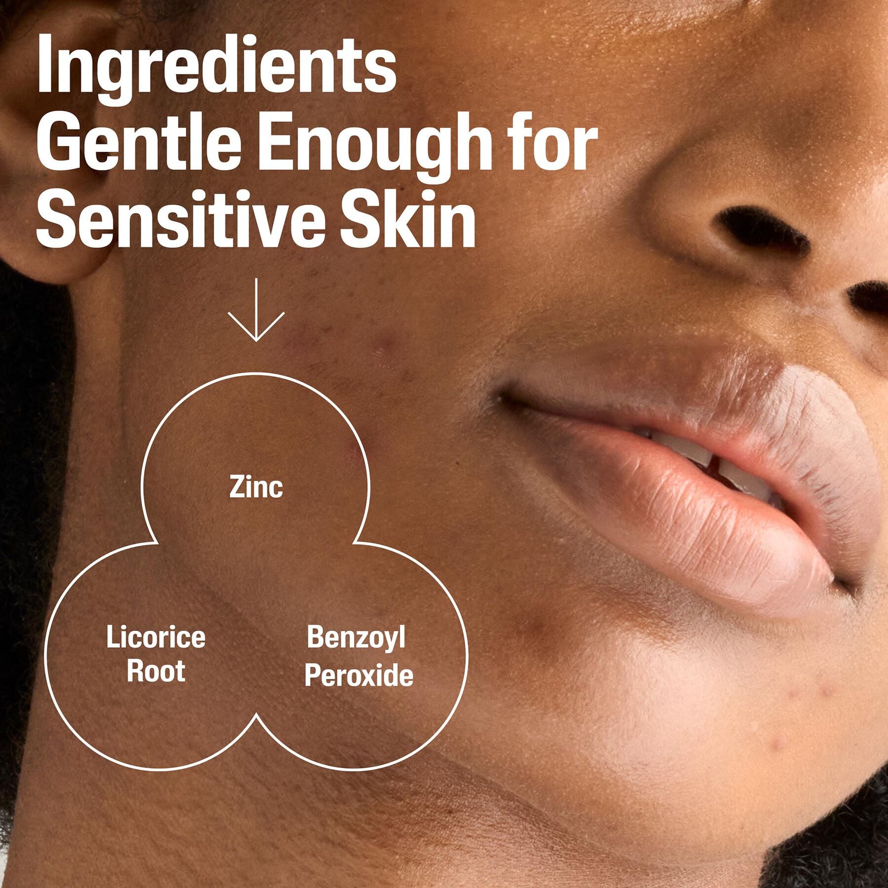 FSA Eligible Cetaphil Gentle Clear Complexion Clearing Acne Cleanser, 4 ...
